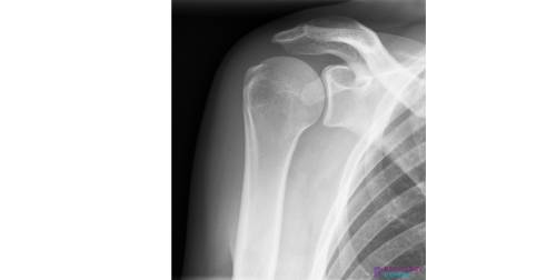 X-Shoulder