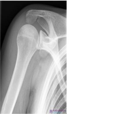 X-Shoulder