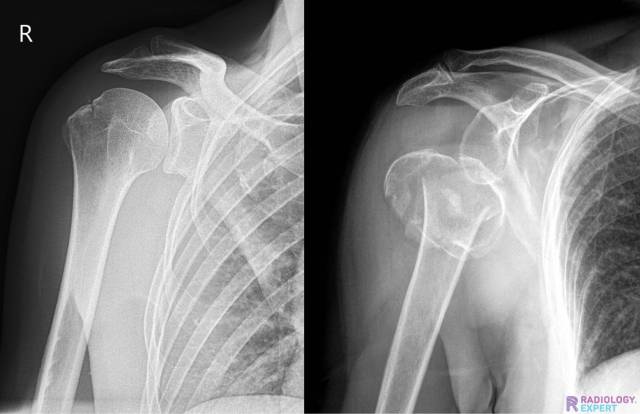 Humerus X Ray