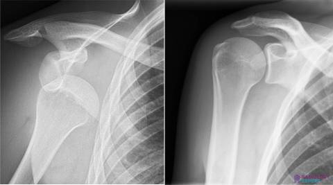 Shoulder Joint X Ray