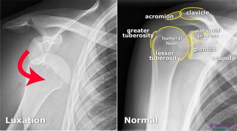 Broken Shoulder X Ray