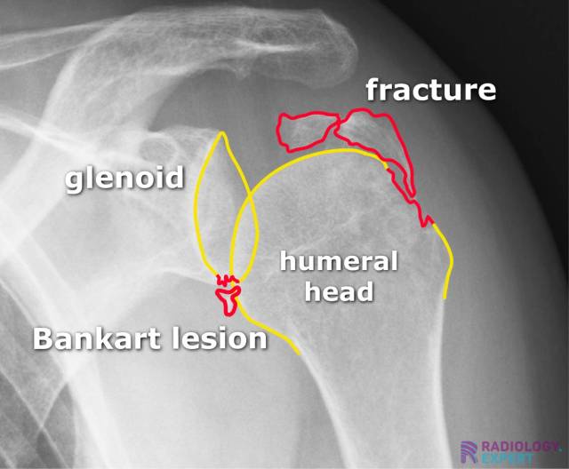 Mechanisms Of Humeral Head Fracture