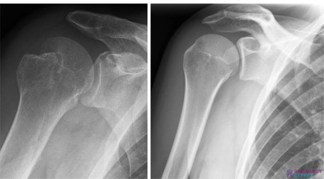 Normal Humerus X Ray