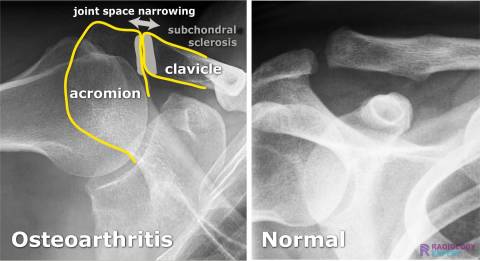 Subchondral Sclerosis