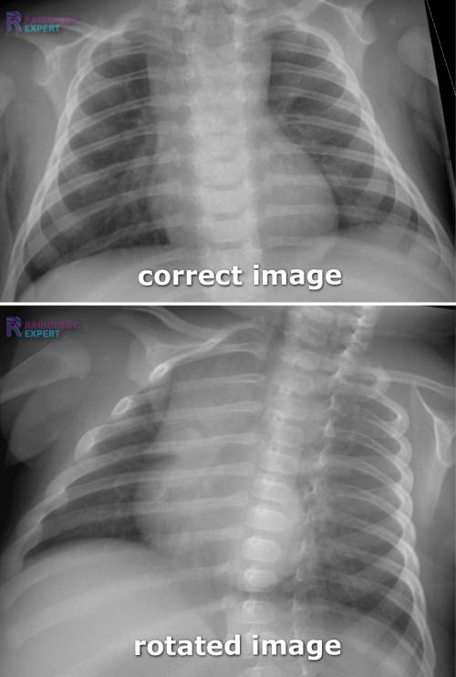 Chest X-ray child