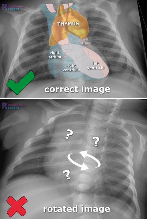 Chest X-ray child