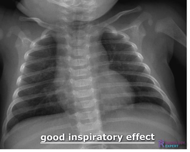 Normal Chest X Rays Pictures Chest X Ray Findings In 636 Ambulatory
