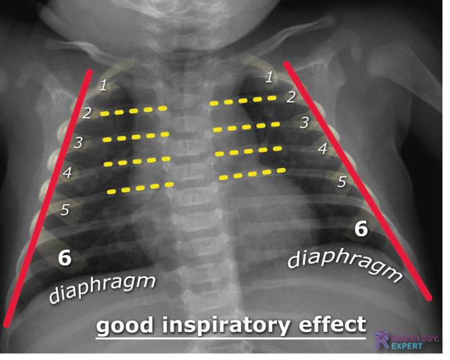 Normal Chest X Rays Pictures Chest X Ray Findings In 636 Ambulatory