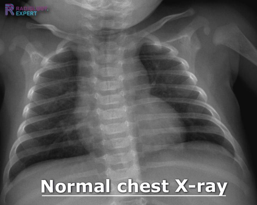 Chest X-ray child