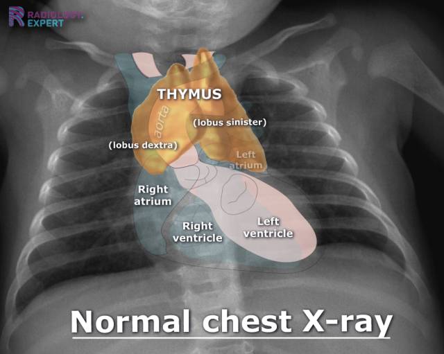 Chest X-ray child