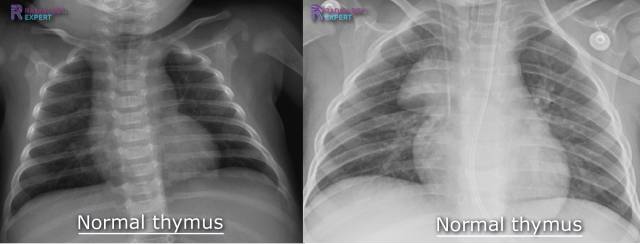 Normal Child Chest X Ray
