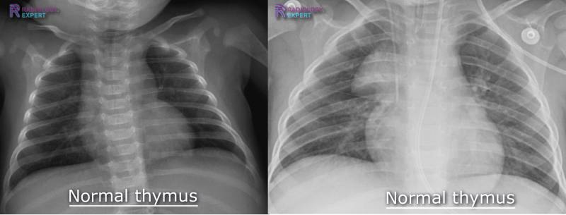 Chest X-ray child