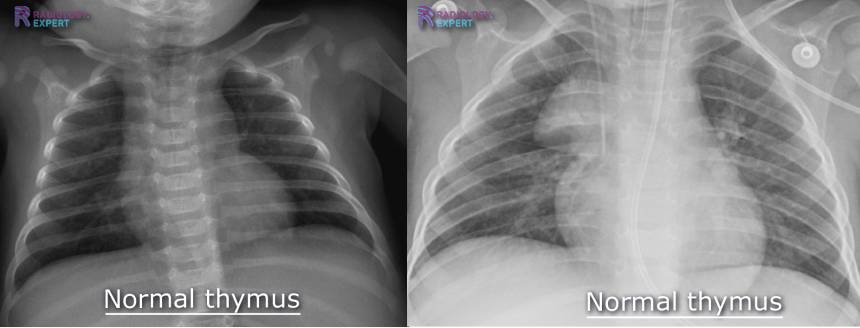 Chest X-ray child