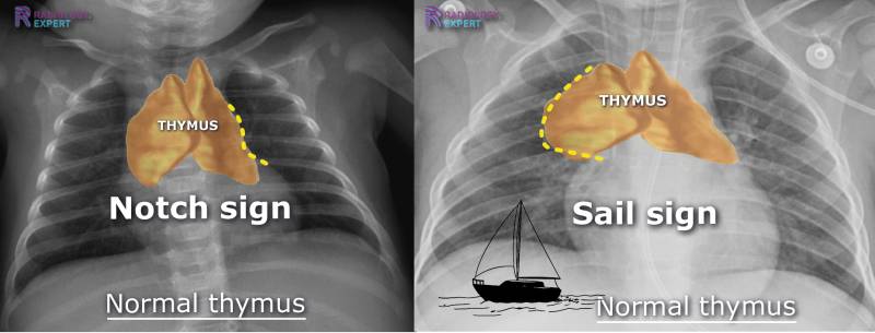 Chest X-ray child
