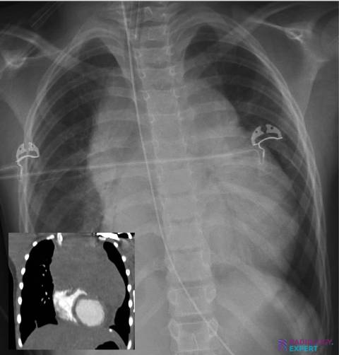 Chest X-ray child