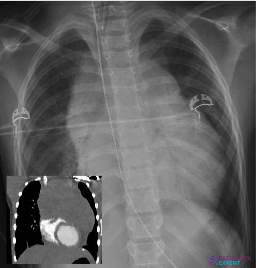 Chest X-ray child