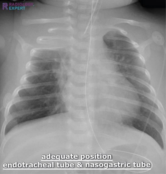 Chest X-ray child