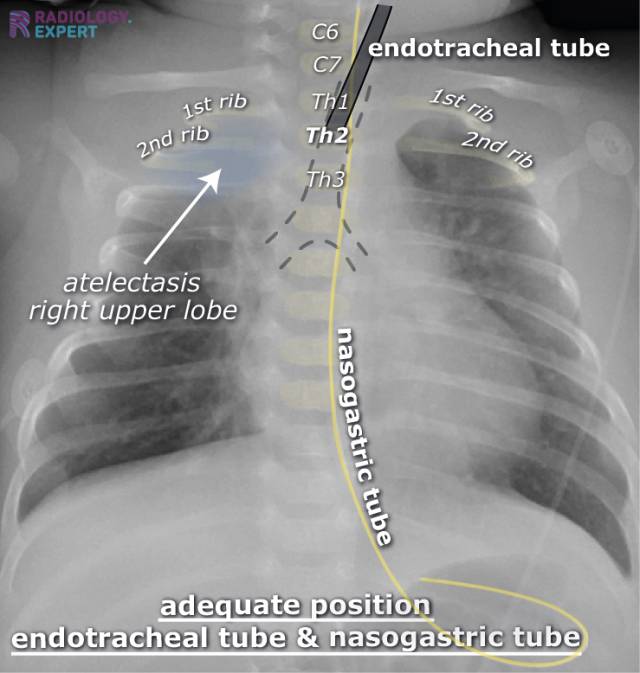 Chest X-ray child