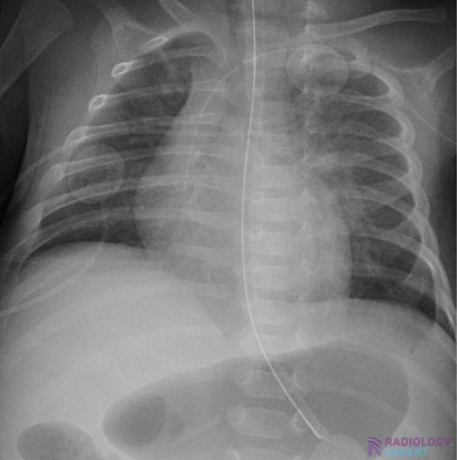 Chest X-ray child