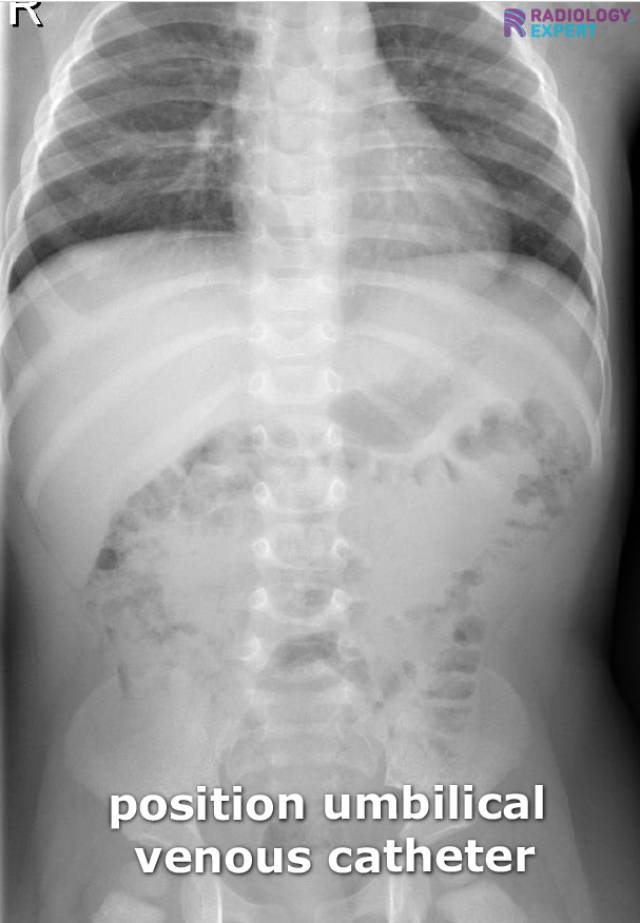 Chest X-ray child
