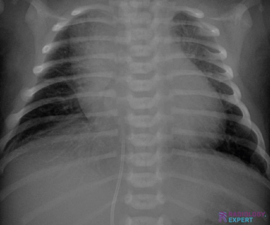 Chest X-ray child