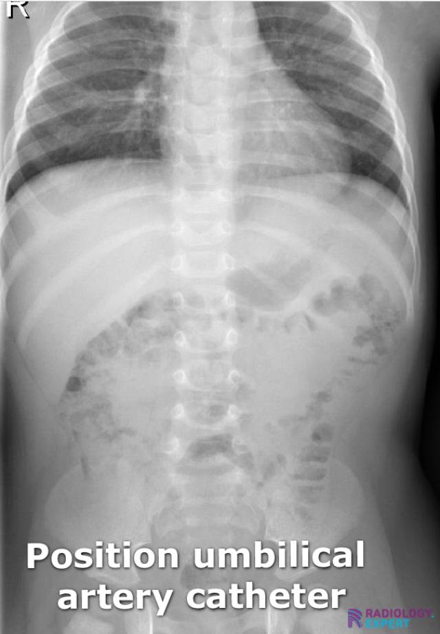 Chest X-ray child