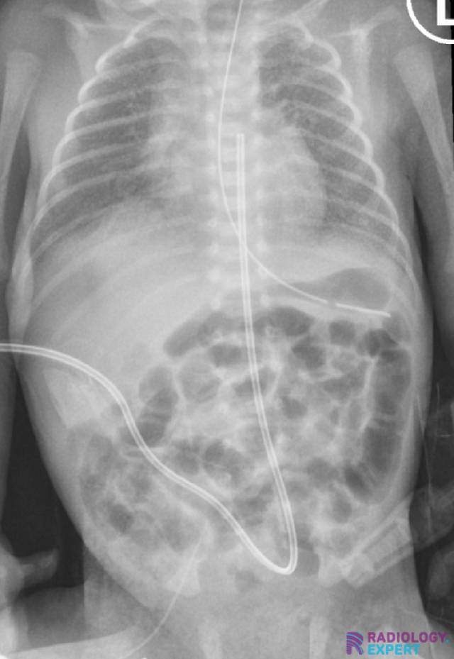 Chest X-ray child