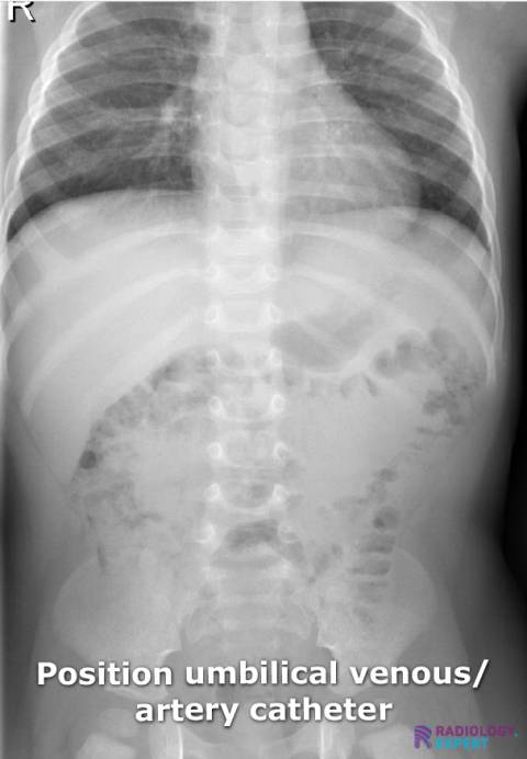 Chest X-ray child