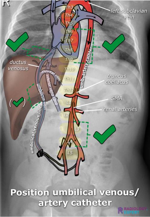 Chest X-ray child