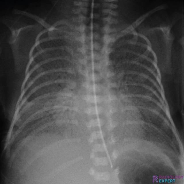 Chest X-ray child