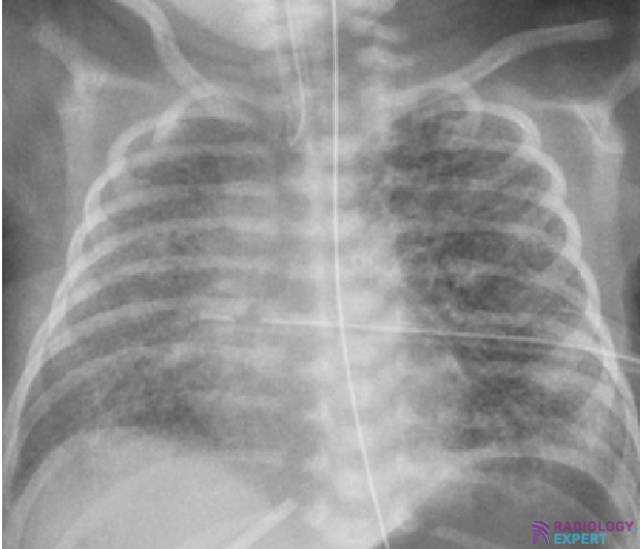 Chest X-ray child