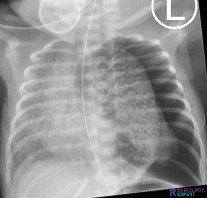 Chest X-ray child