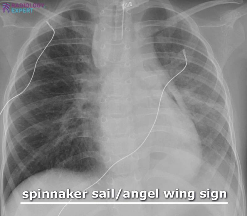 Chest X-ray child