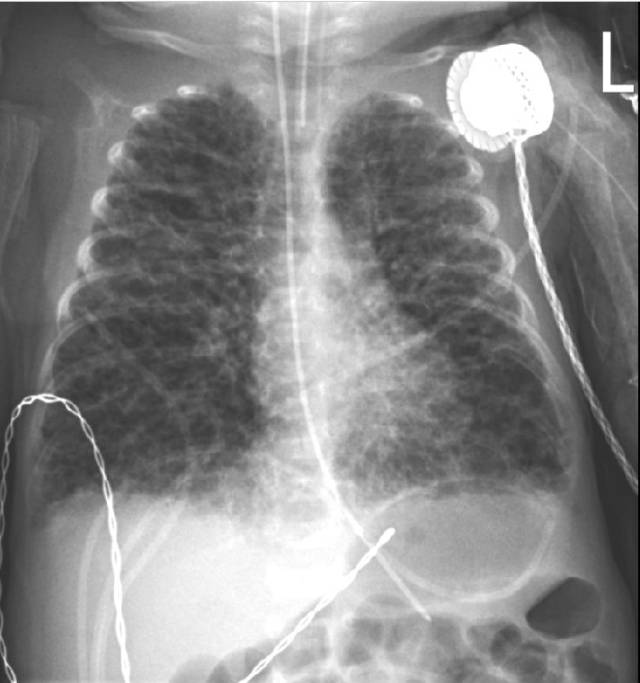 Chest X-ray child