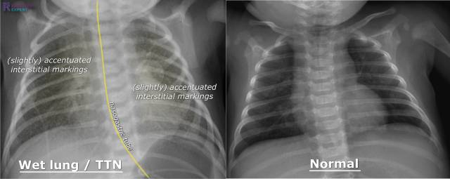 Normal Infant Chest Xray