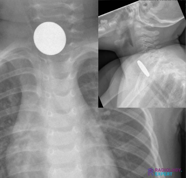 Chest X-ray child