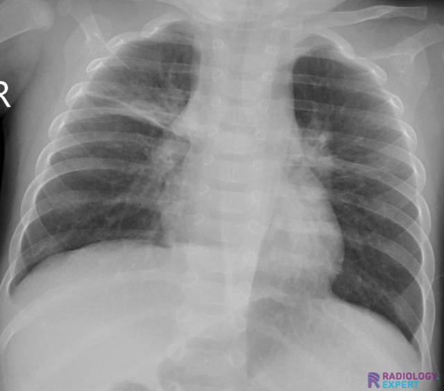 Chest X-ray child