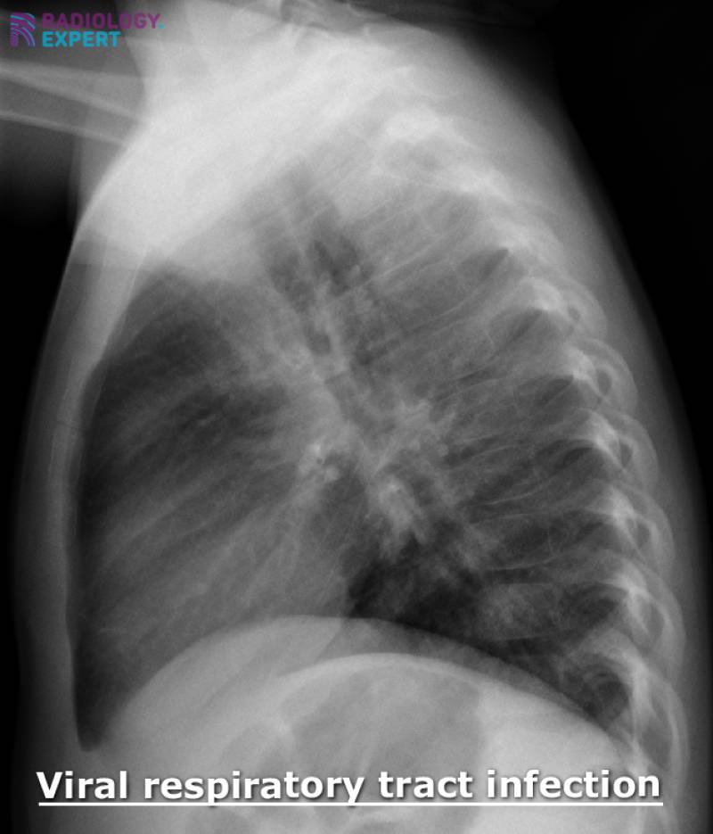 Chest X-ray child