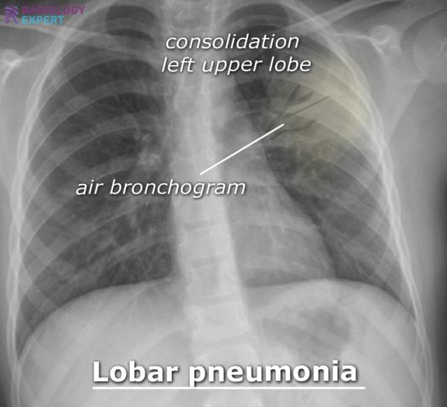 Pnuemonia On A Chest X Ray