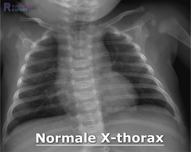 X-Thorax kind