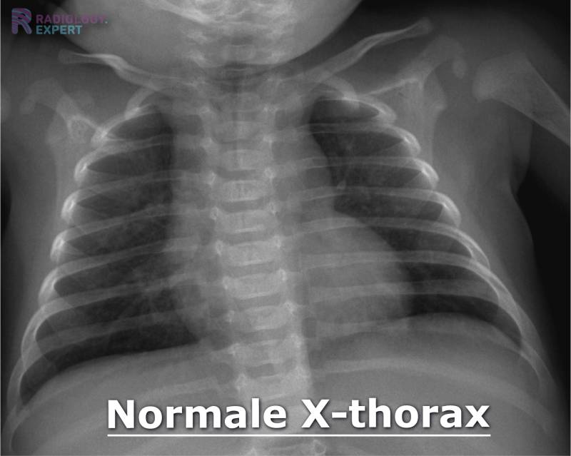 X-Thorax kind