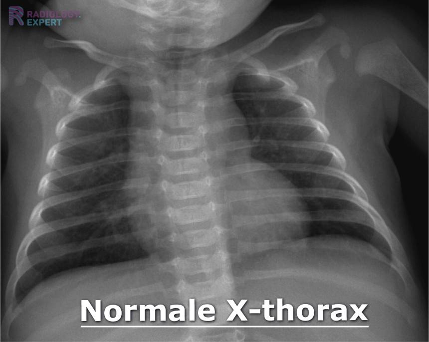 X-Thorax kind