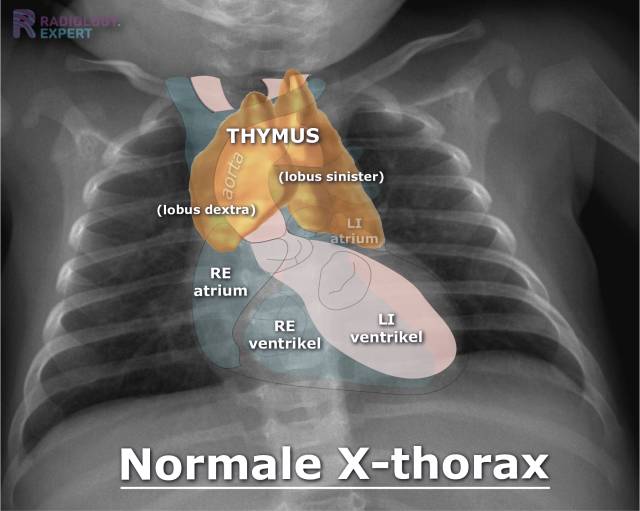 X-Thorax kind