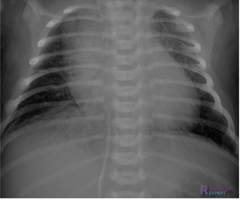X-Thorax kind