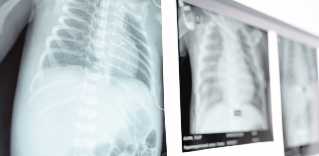 Chest X-ray child