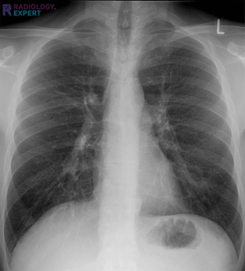 Chest X-ray ICU