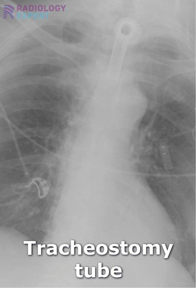 Chest X-ray ICU