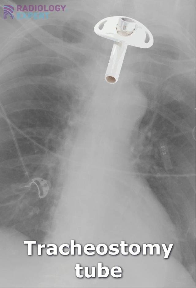 Chest X-ray ICU