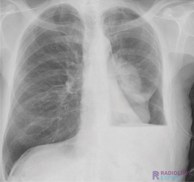 Chest X-ray ICU