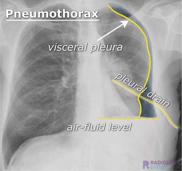 Chest X-ray ICU